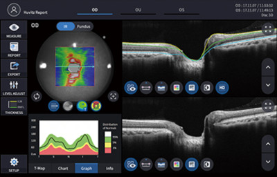 HUVITZ HOCT-1 / 1F - AJL Ophthalmic
